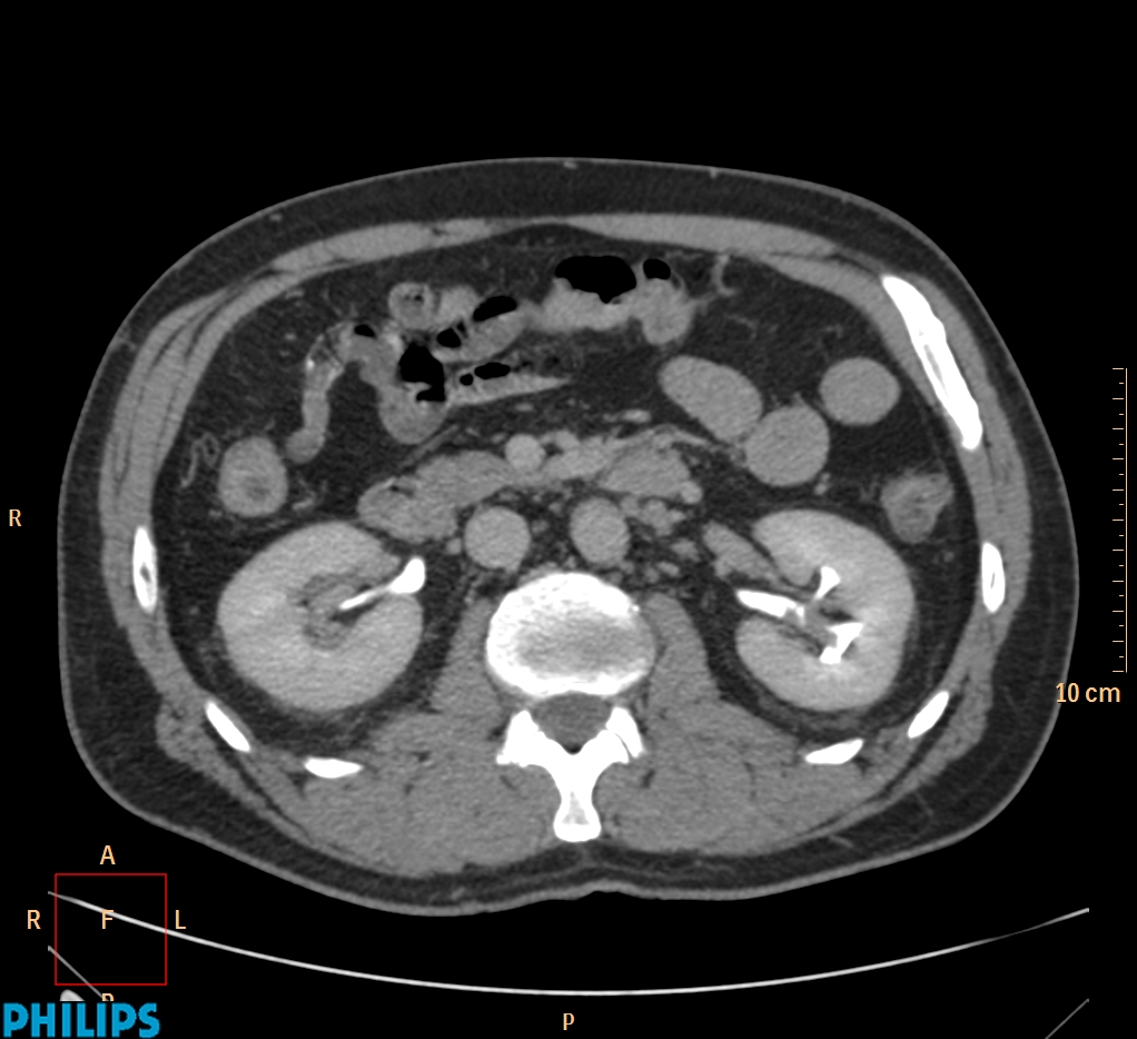 ΚΑΡΚΙΝΟΣ ΝΕΦΡΟΥ ΑΠΟ ΜΕΤΑΒΑΤΙΚΟ ΕΠΙΘΗΛΙΟ | ΙΠΠΟΚΡΑΤΕΙΟ ΙΩΑΝΝΙΝΩΝ e-learning